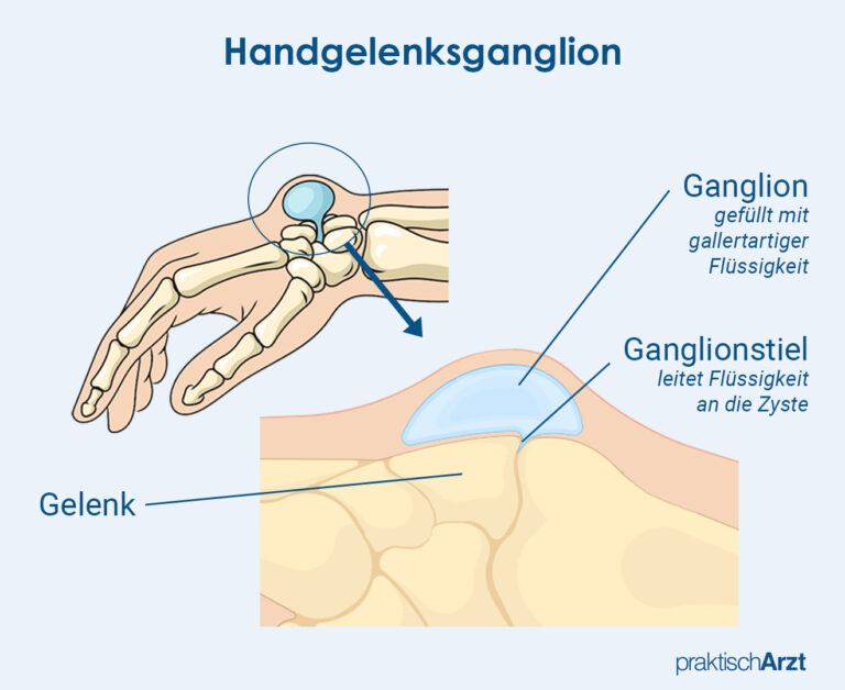 Handgelenksganglion (Überbein): Symptome und Behandlung