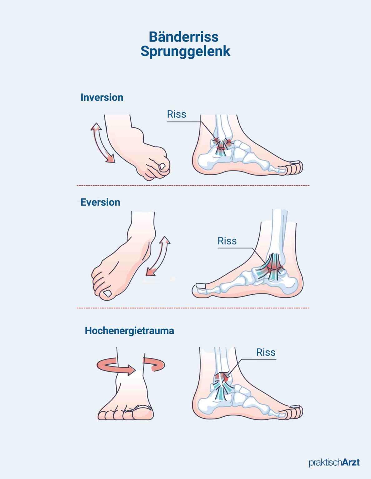 Bänderriss (Sprunggelenk): Ursachen & Behandlung