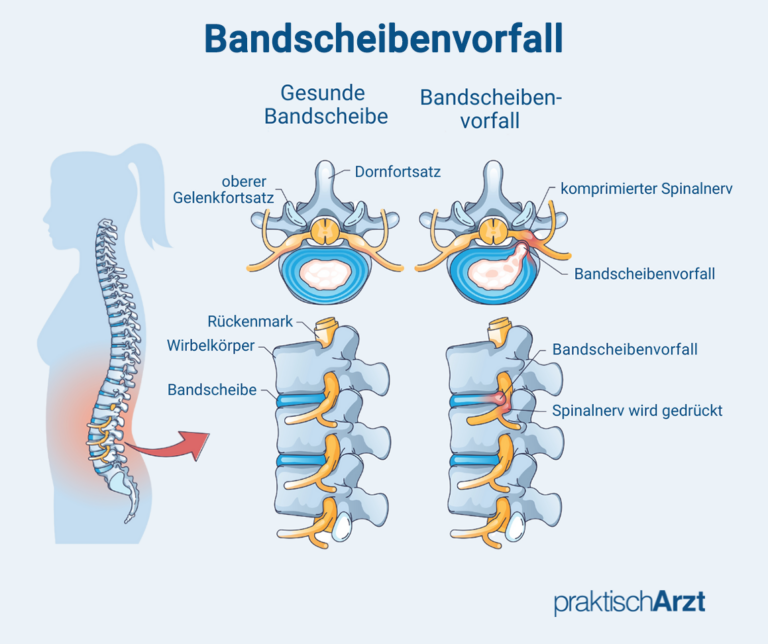Bandscheibenvorfall-Übungen und weitere Tipps